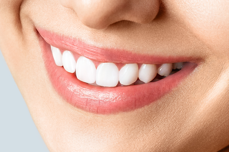 Veneers for Stained Teeth: What Works When Whitening Fails - Dr Joy ...